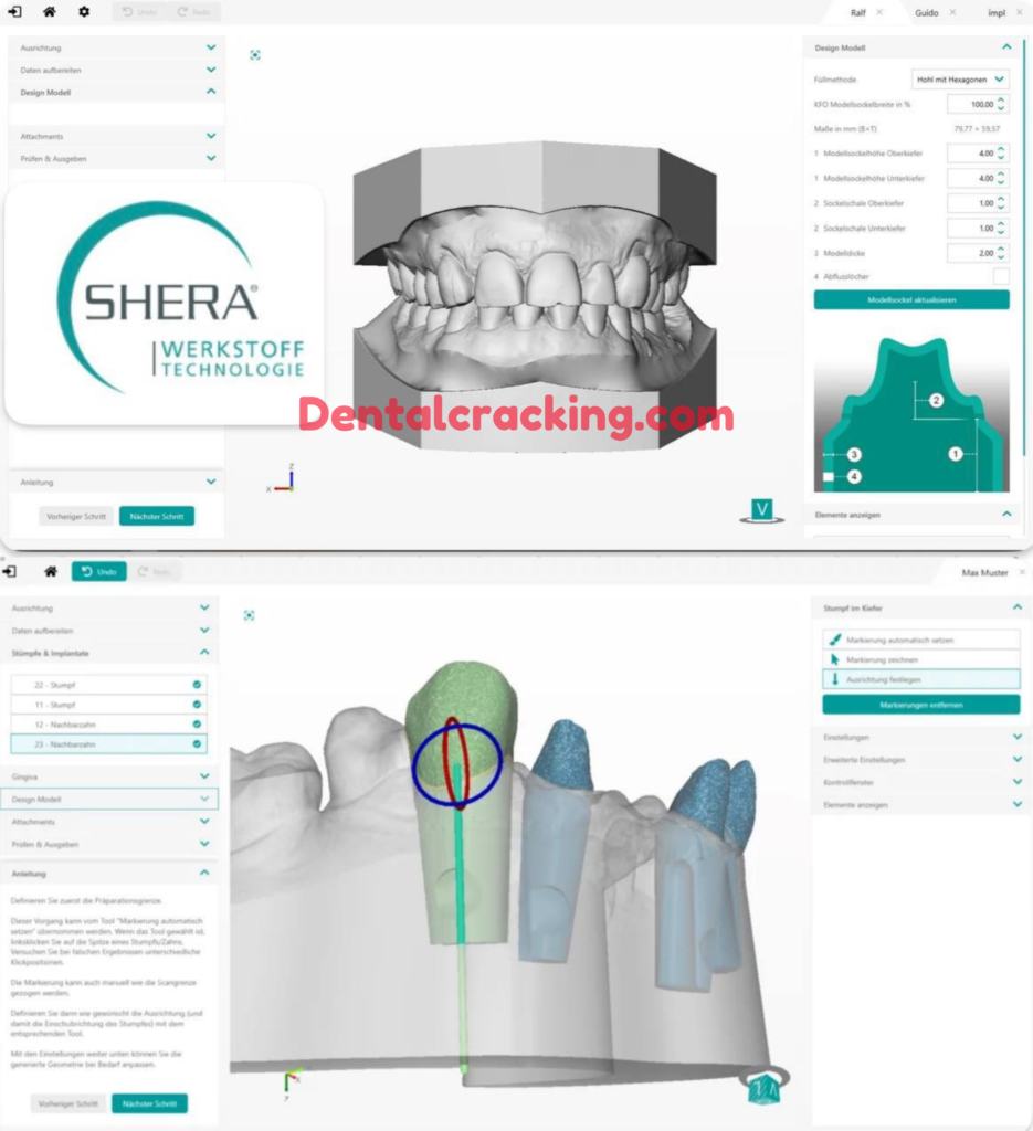 Shera Easy Model Crack: Dental CAD Software for Labs & Offices